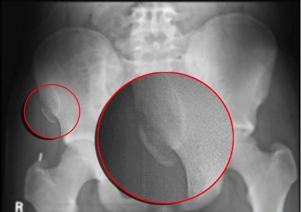 Avulsion Fractures Bone Fracture And Repair